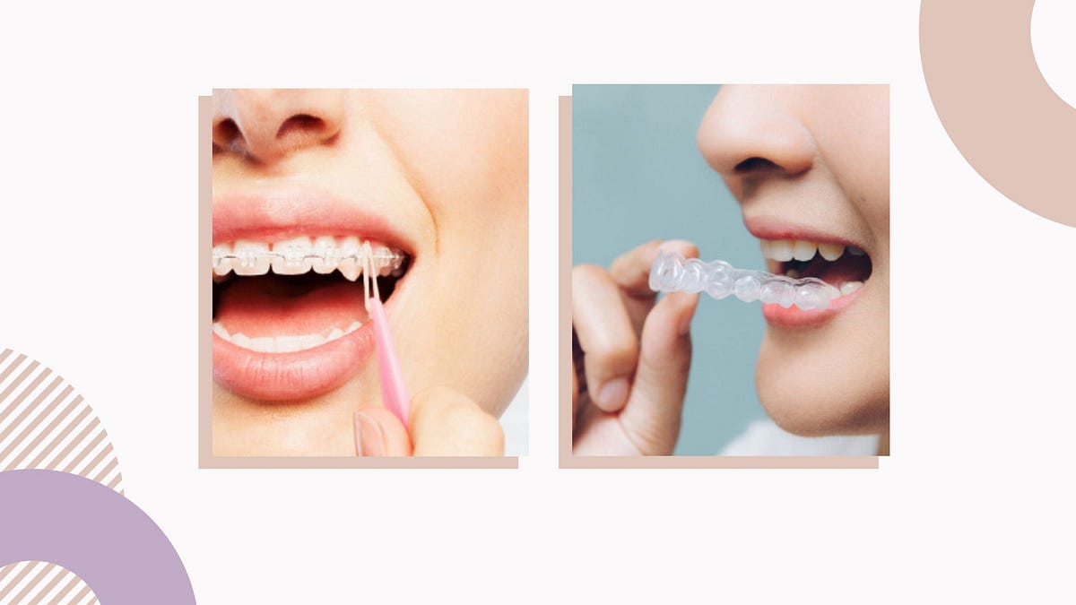 Braces vs. Invisalign: Choosing the Right Orthodontic Treatment for You | by Kabir Burman | Jun ...