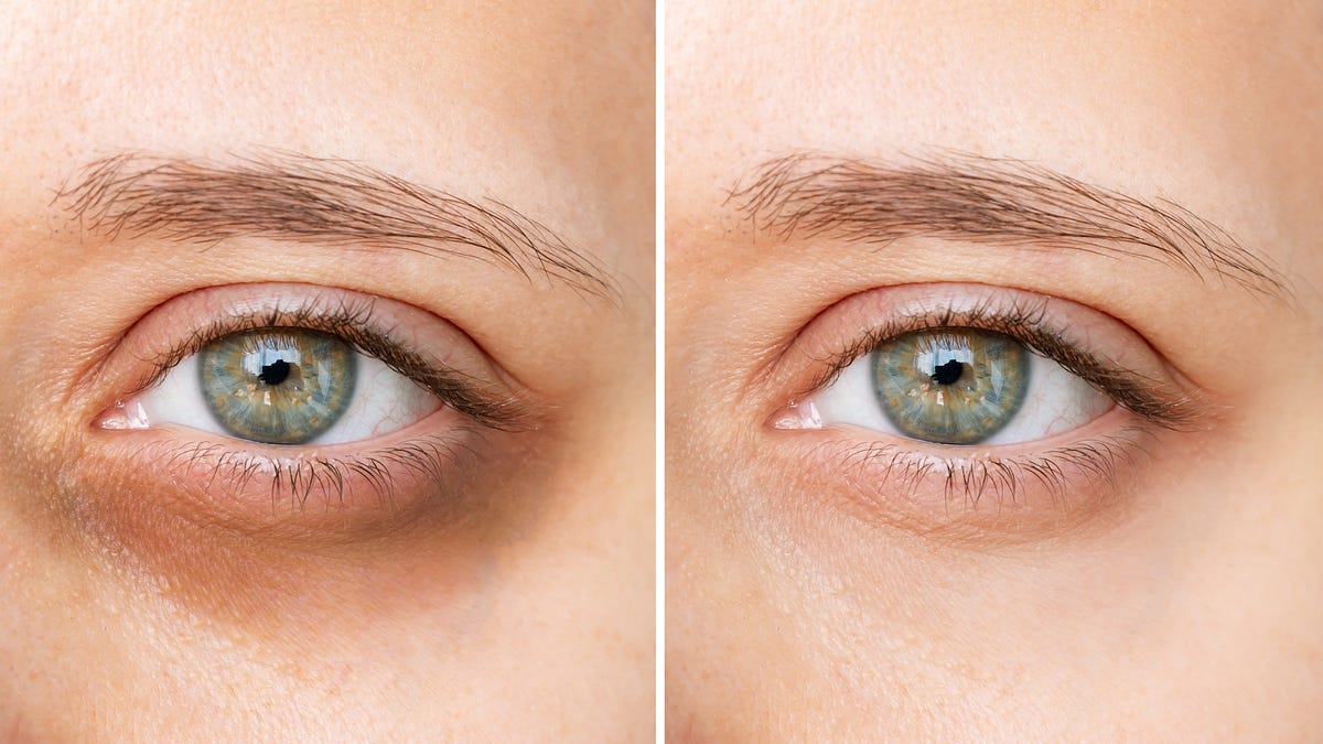 Banish Dark Circles: The Ultimate Guide to Transforming Tired Eyes | by ...