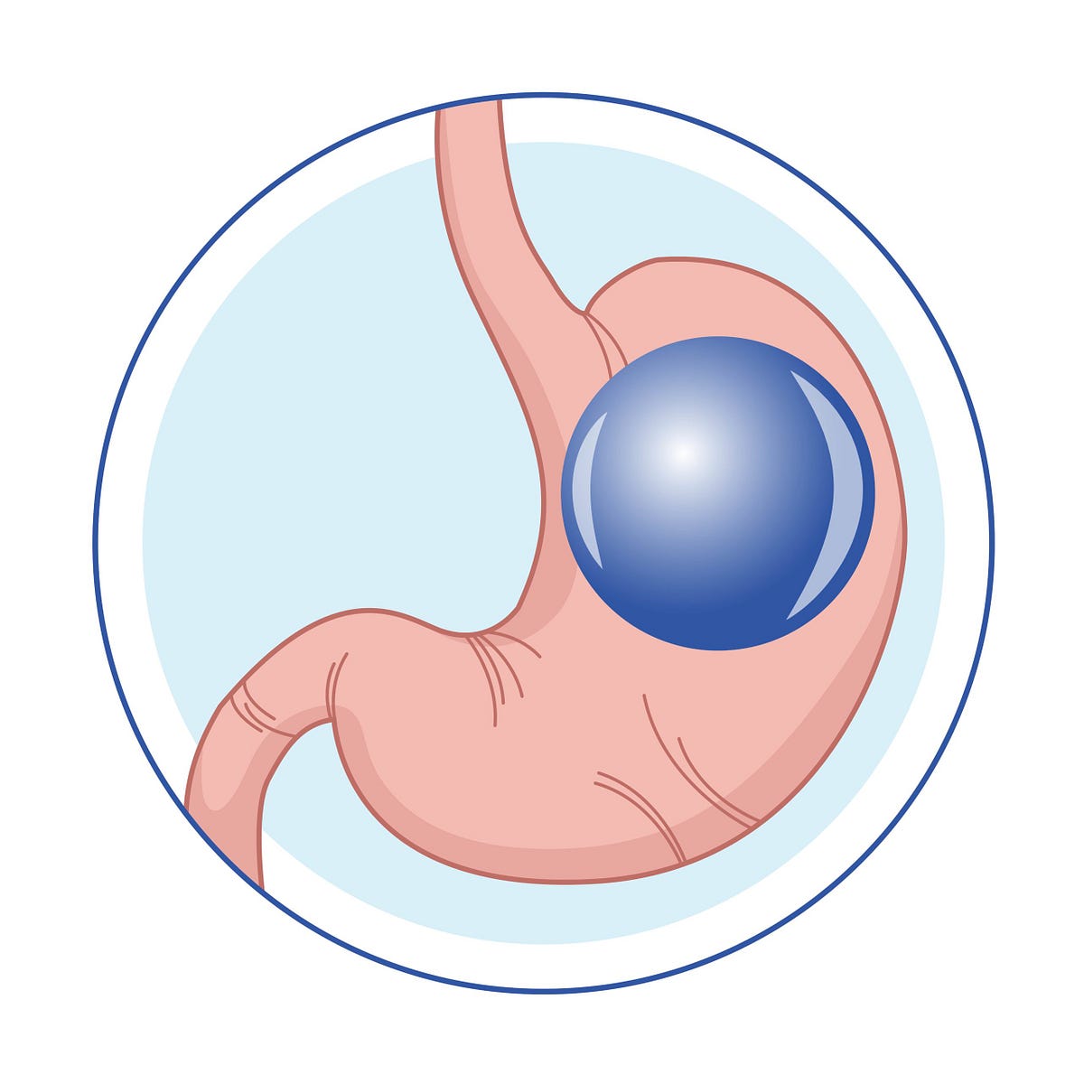 Gastric Balloon Placement: A Step-by-Step Guide | by Royalclinicuae ...