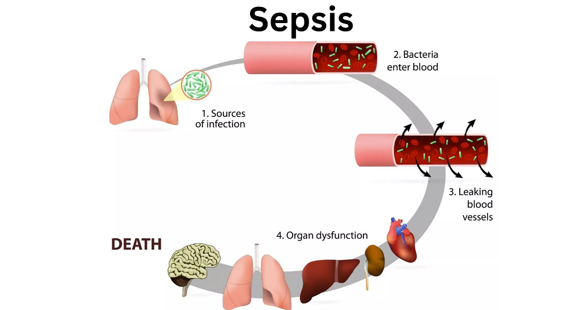 Acute Renal Failure Analysis with Sepsis Data | by Kinjal Thakkar | Medium