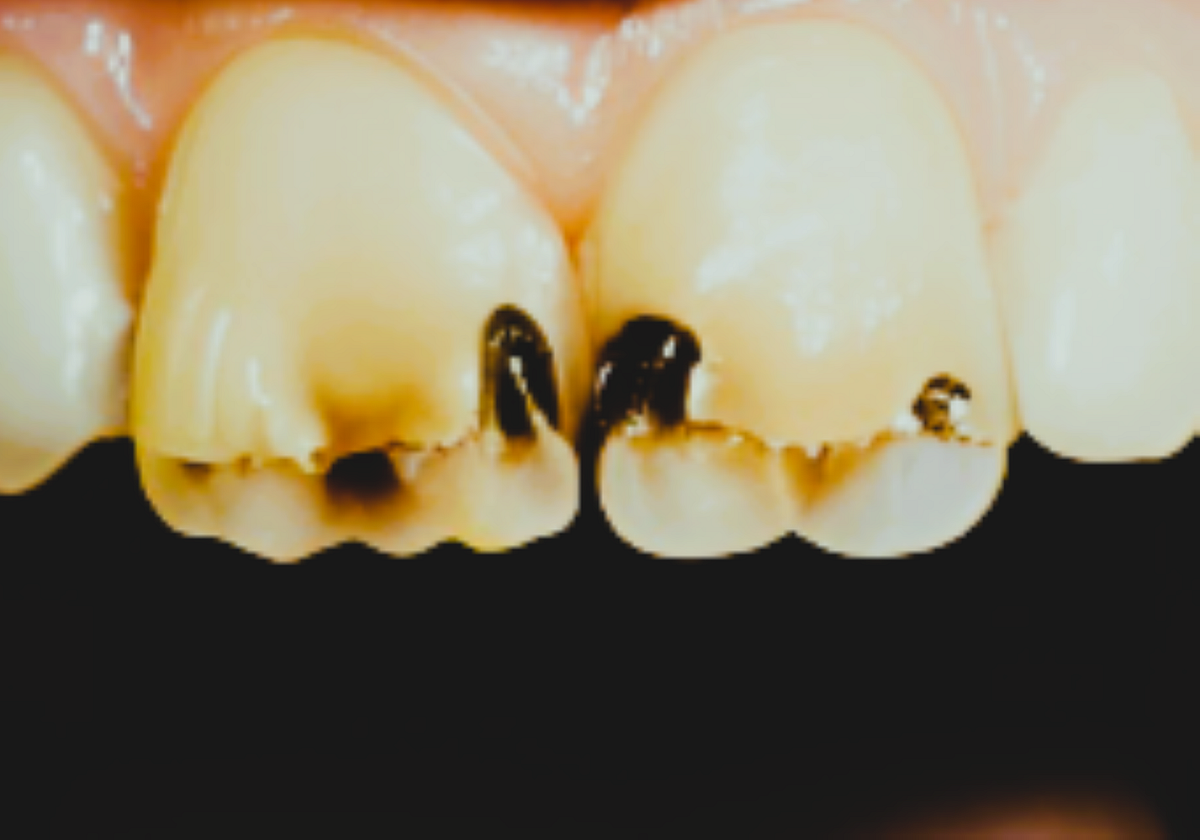 Stop Assuming Everyone with Bad Teeth is a Drug Addict | by Suzy ...