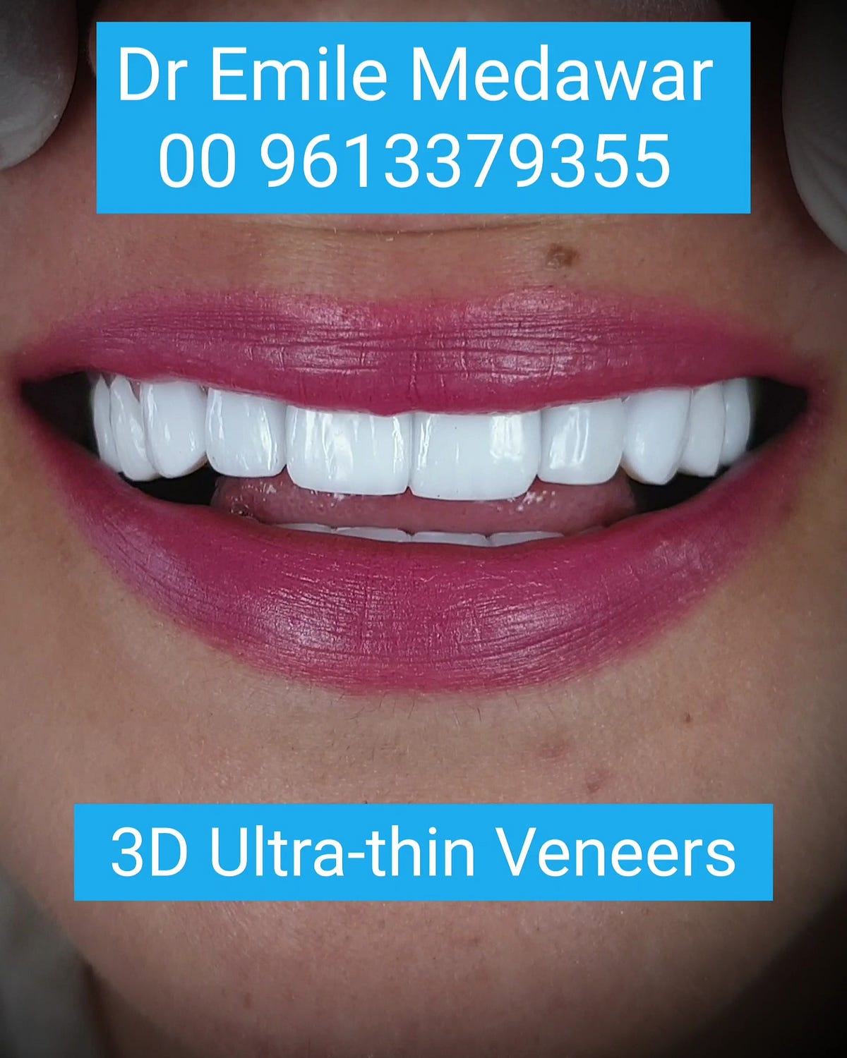 Ultra-Thin Porcelain Dental Veneers, Dr Emile Medawar, Cosmetic Dentist ...
