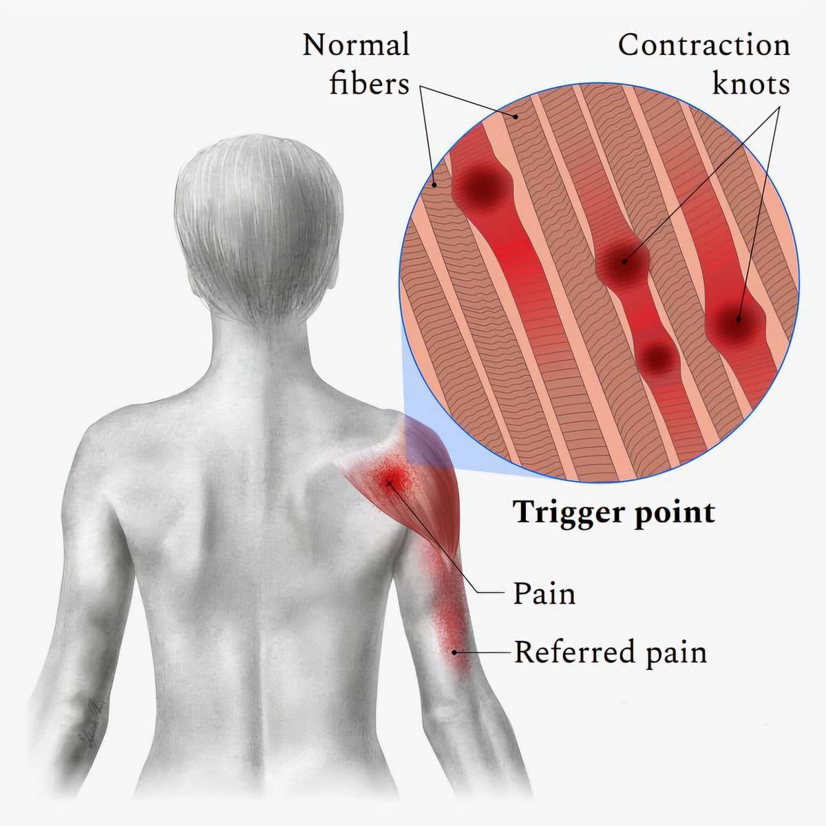 📝 Several new interesting facts about myofascial trigger points: | by ...