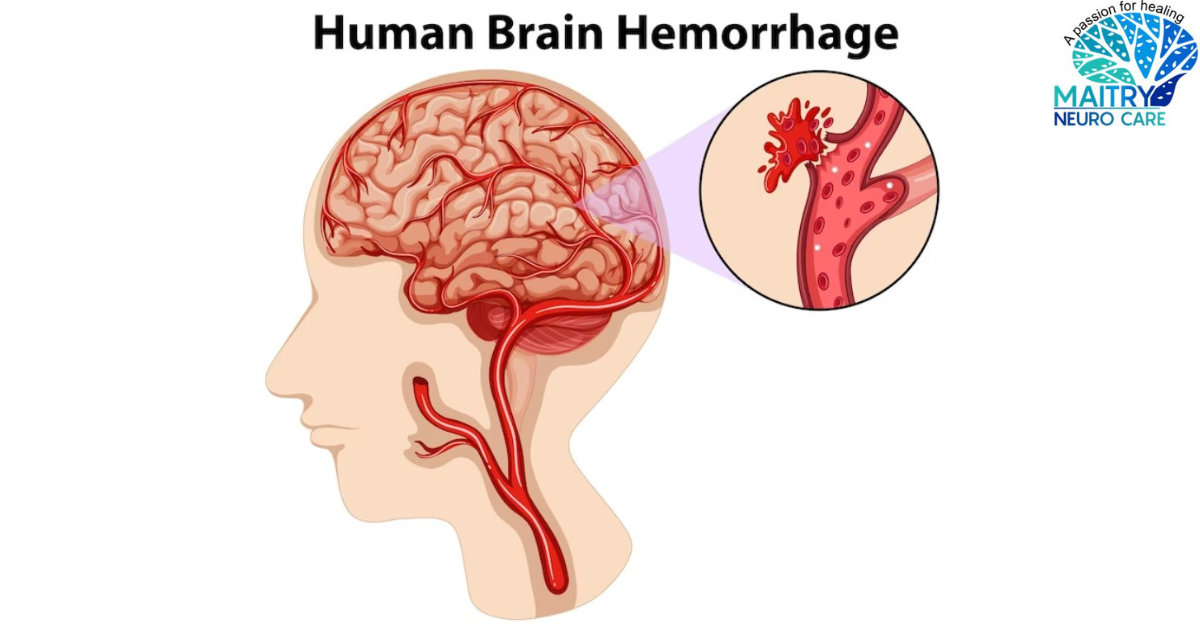 The Ultimate Guide to Brain Hemorrhage: What You Need to Know | by ...