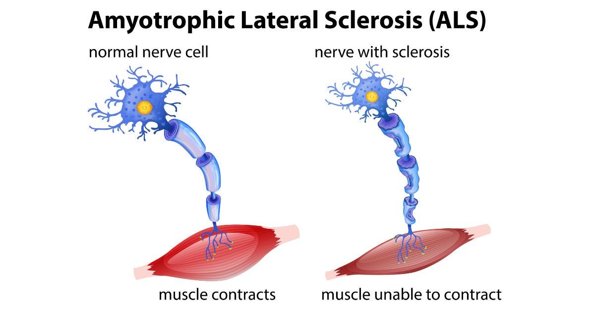 ALS Disease Demystified: Regulatory Guidance for Pharma Companies | DLI ...