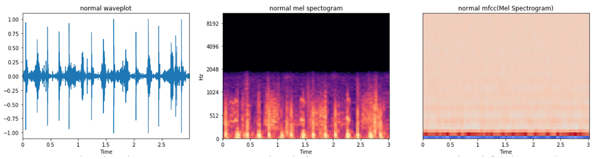 Heart Anomaly Detection by Analysing Stethoscope sounds using Deep ...