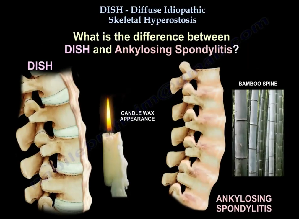 Global Knowledge Gap in Diagnosing DISH vs. Ankylosing Spondylitis ...