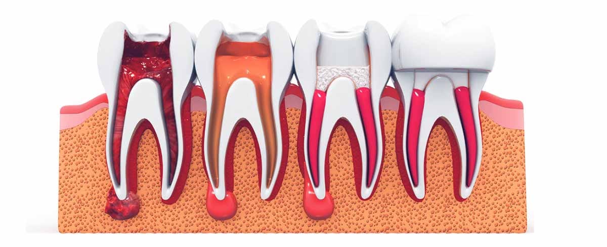 The Facts Behind Painless Root Canal Treatment | by Sanikanaik | Dec ...