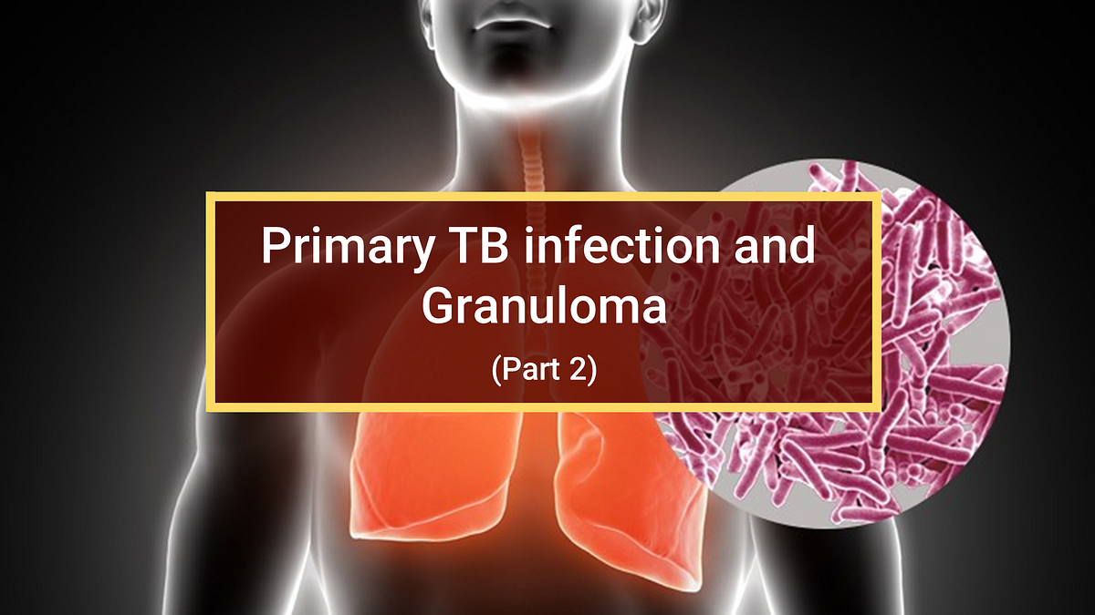 Granuloma formation in primary TB infection (Part 2) | by Roohi Bansal ...