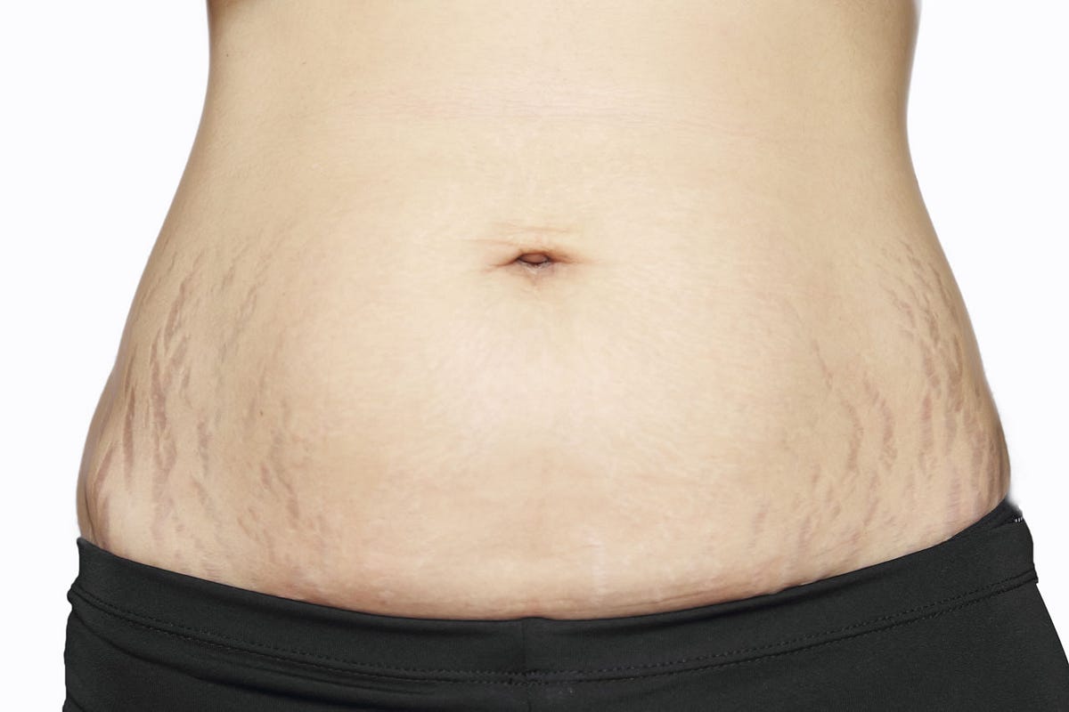 Stretch Marks — Causes, Treatment and Prevention. | by Dr Renita Rajan ...