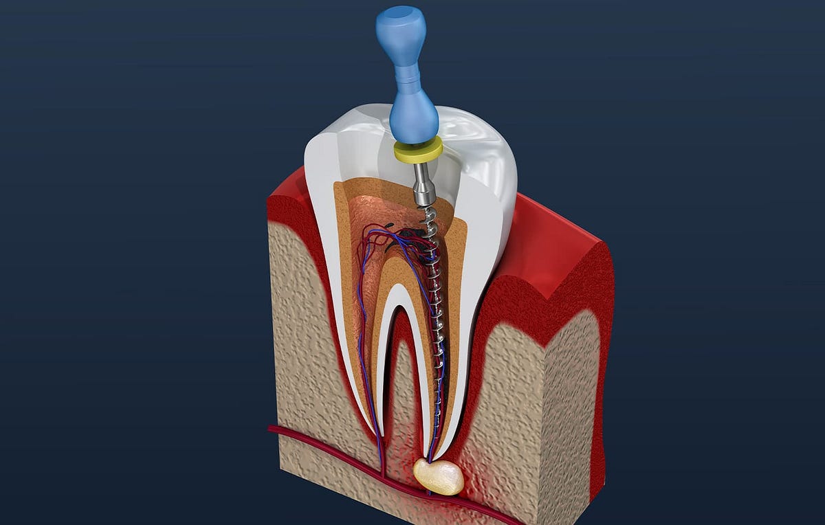 what is root canal treatment?. Define of root canal trearment: | by Md ...