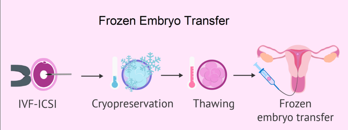 Understanding the Benefits of Frozen Blastocyst Transfer | by Joyce IVF ...