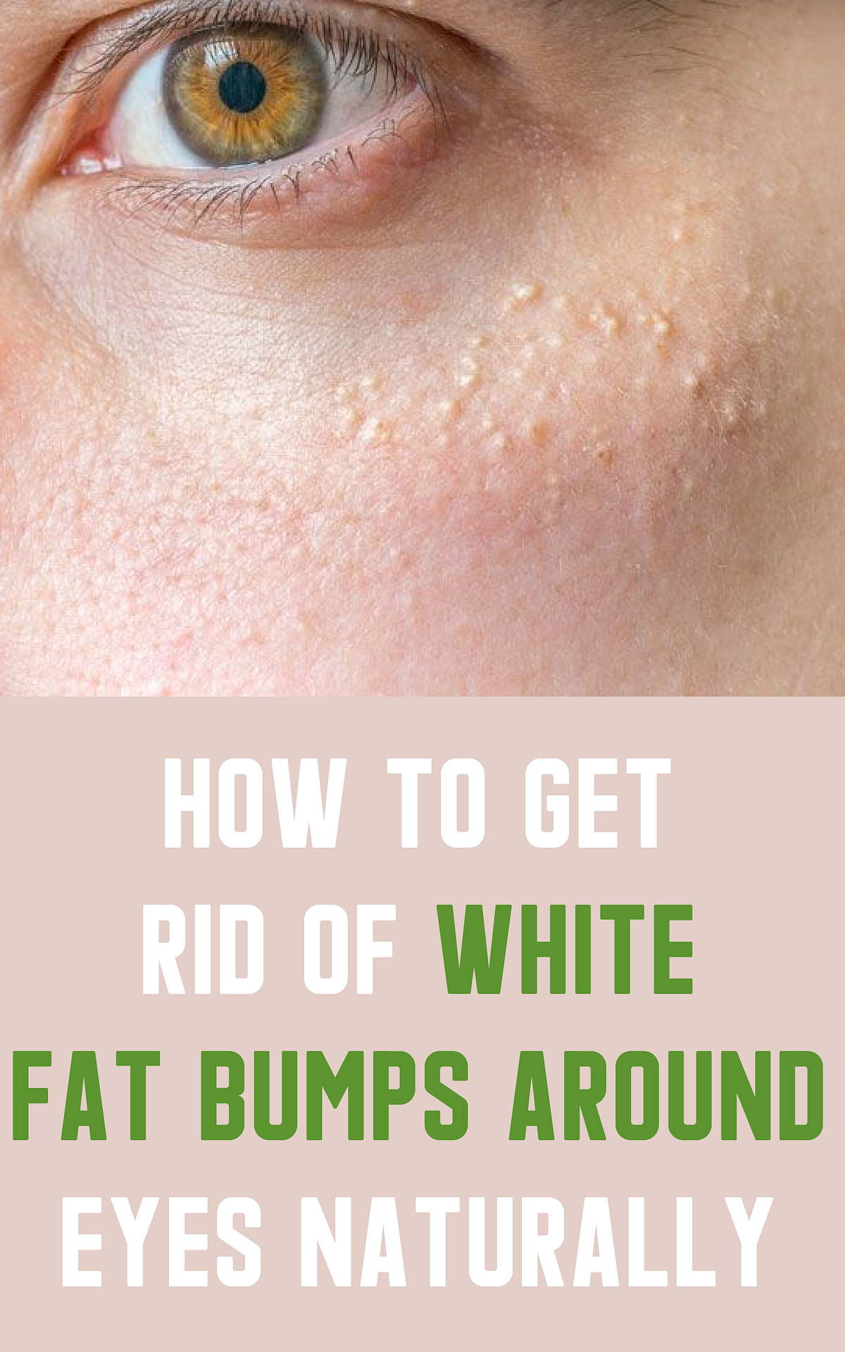 How To Get Rid of White Fat Bumps Around Eyes Naturally ...