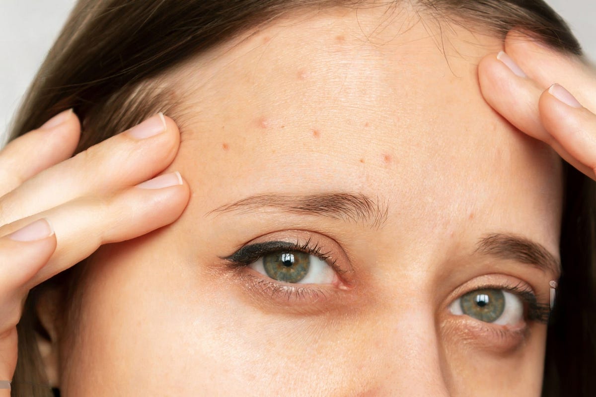 Tired of Forehead Acne? — Causes and Effective Remedies | by Maharukh ...