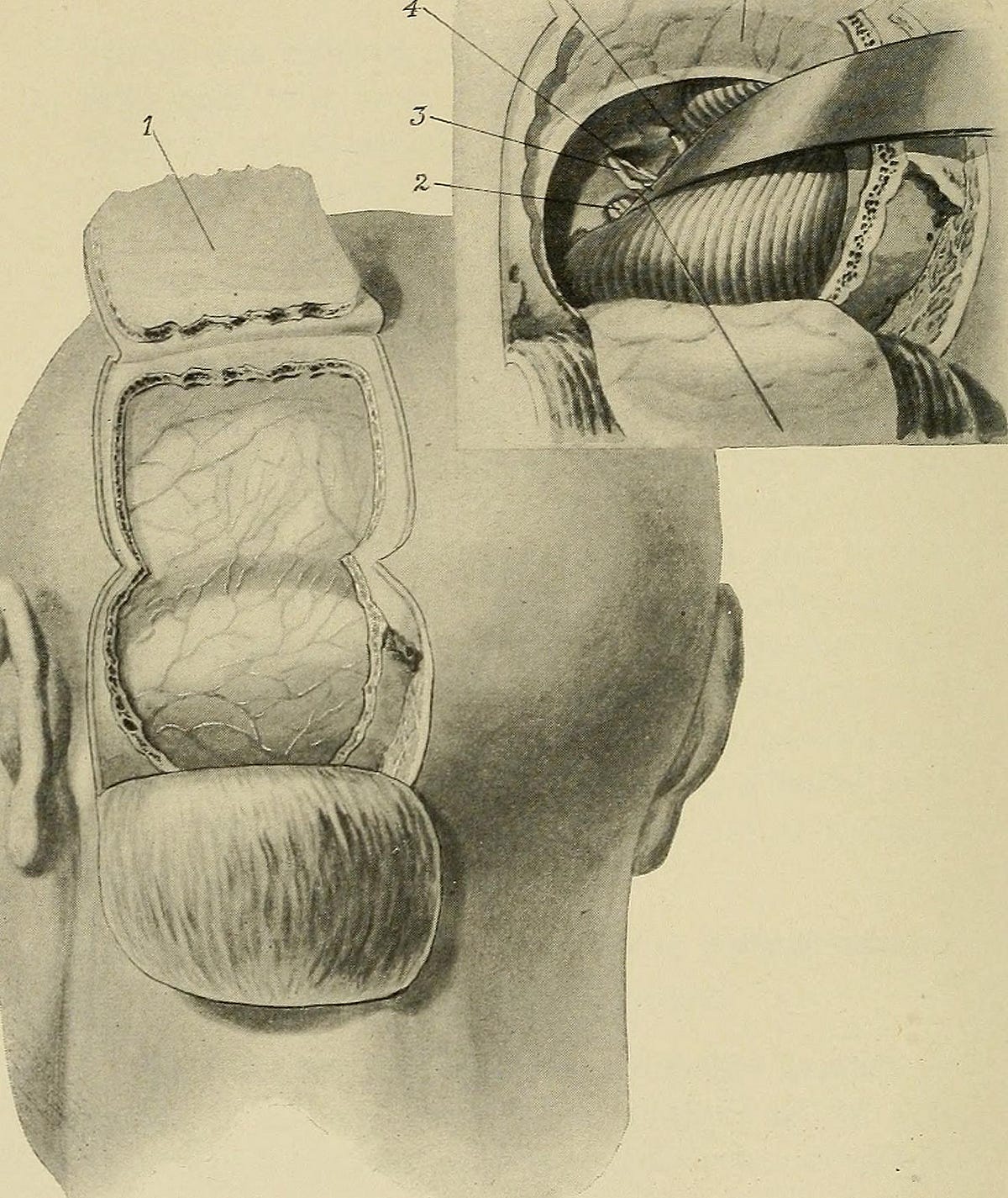 Life Without Your Cerebellum. Tucked away at the back of your brain ...