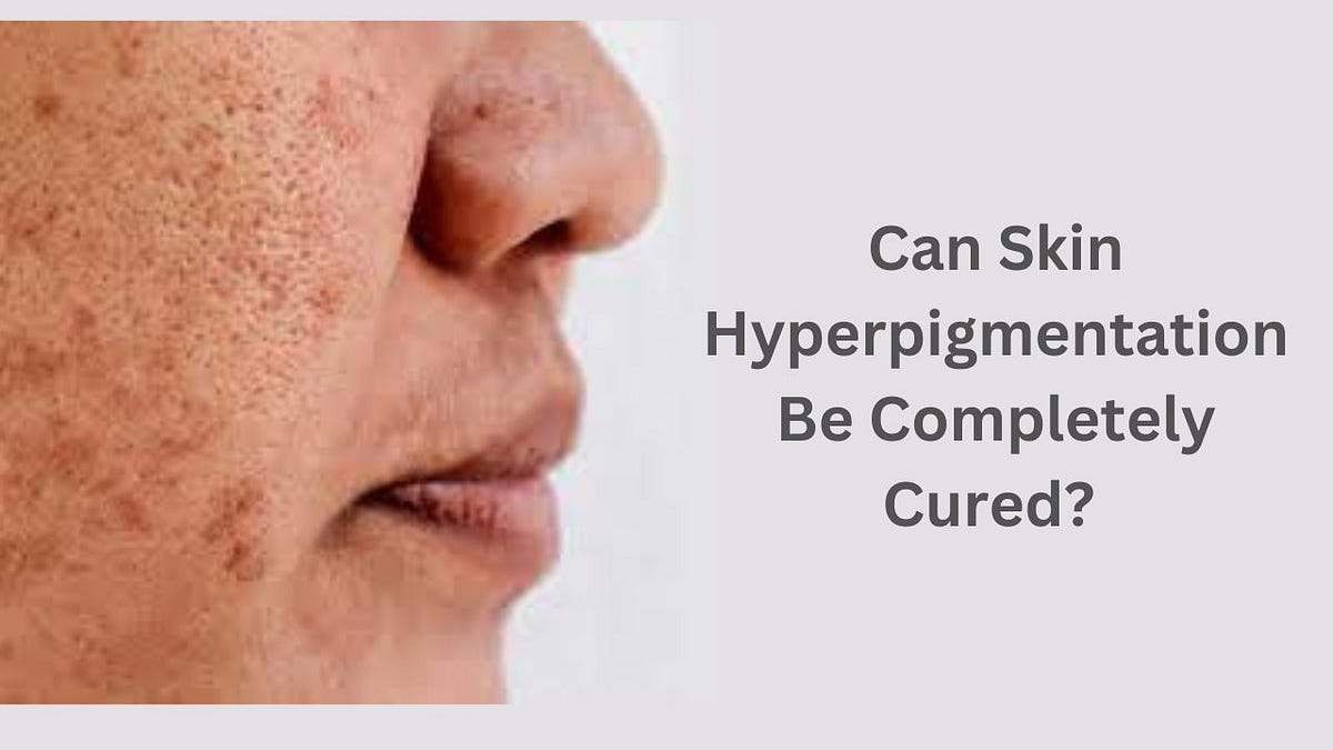 Can Skin Hyperpigmentation Be Completely Cured? Lim Clinic and Surgery ...