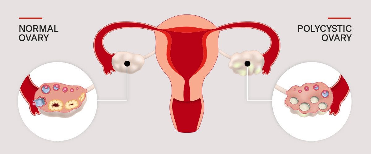 Polycystic Ovary Syndrome (PCOS) and Its Relation To IVF | by Dr ...