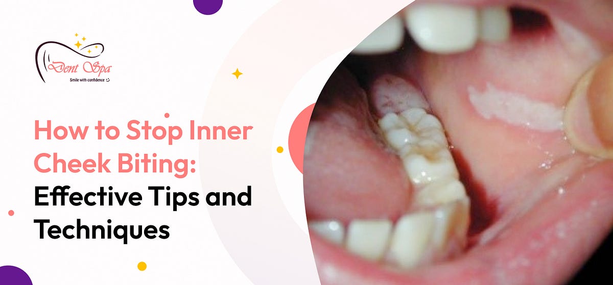 How to Stop Inner Cheek Biting: Tips and Techniques | by Dentspa | Jul ...