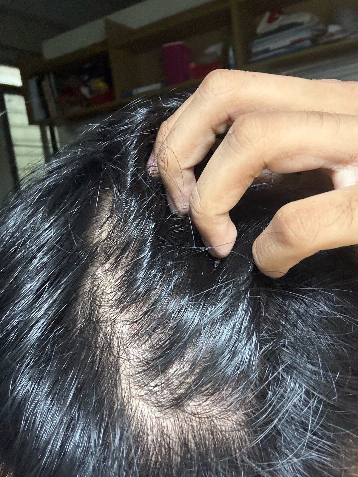 How I Completely Reversed Hair Loss at 19( I Started Losing Hair 16 ...