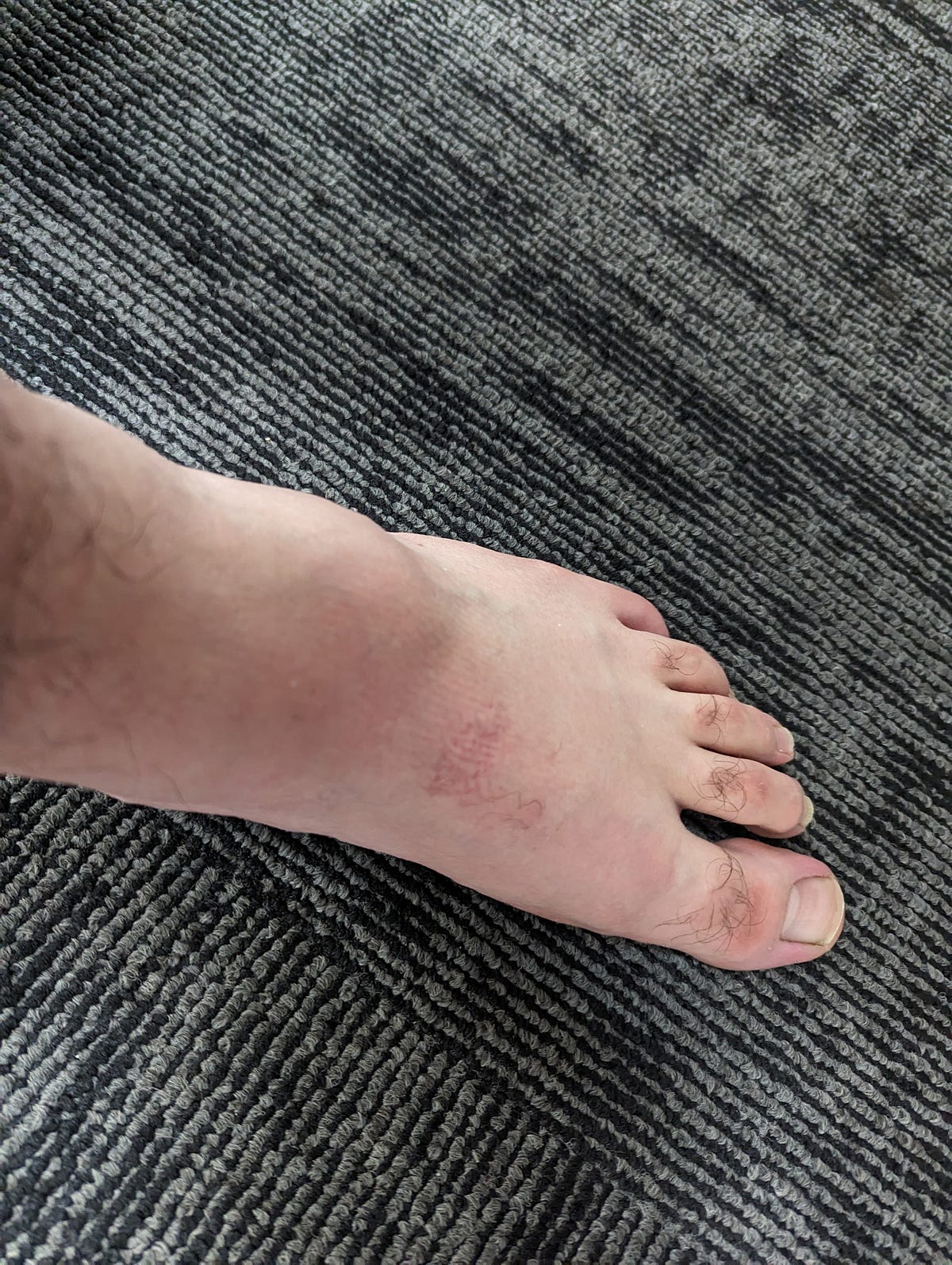 Walking Alone with a Sprained Ankle | by Nicolas Arkilo | Medium