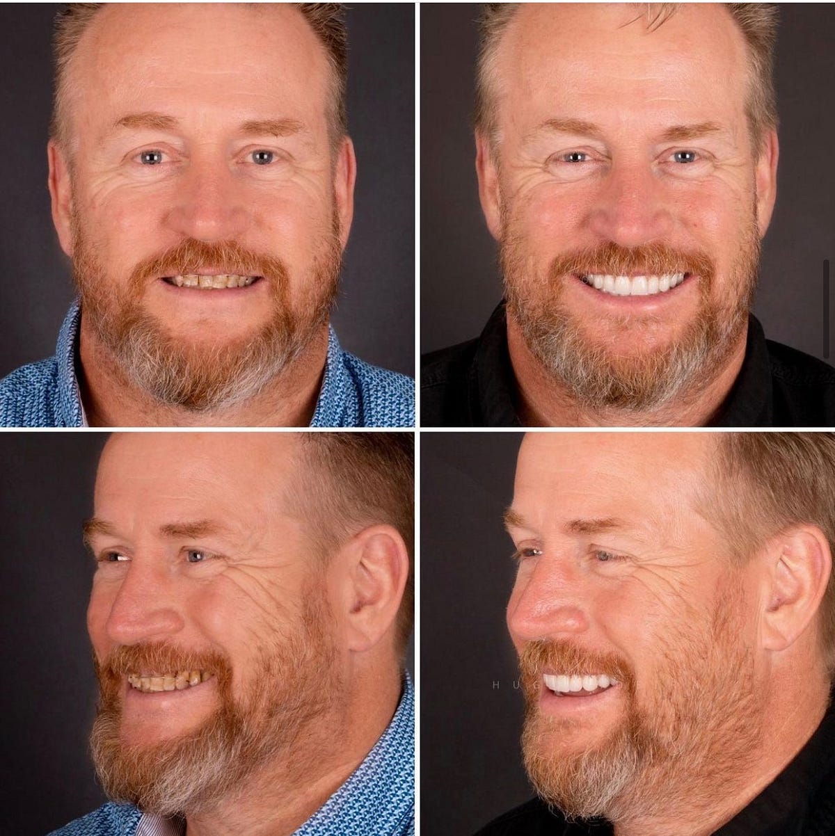 The Dental Implants in Charleston, SC - Hehr Oral & Maxillofacial ...