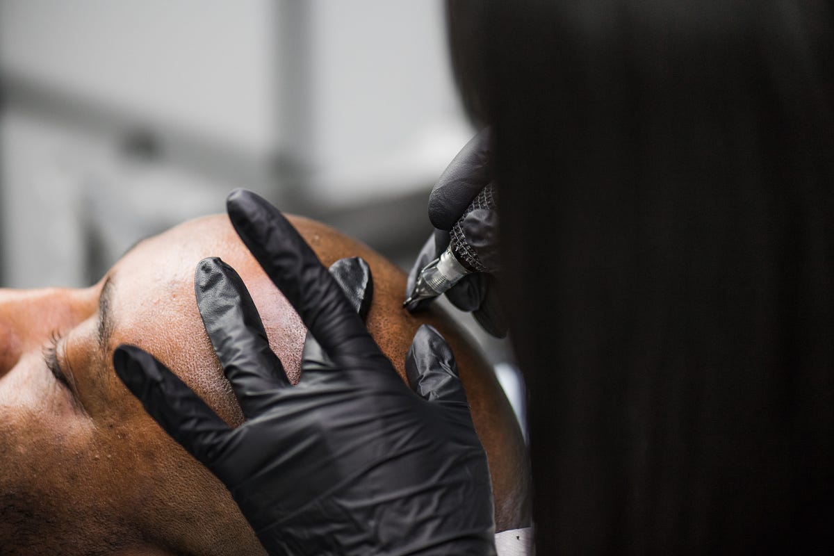 What is Scalp Micropigmentation? - Jessica Cram - Medium