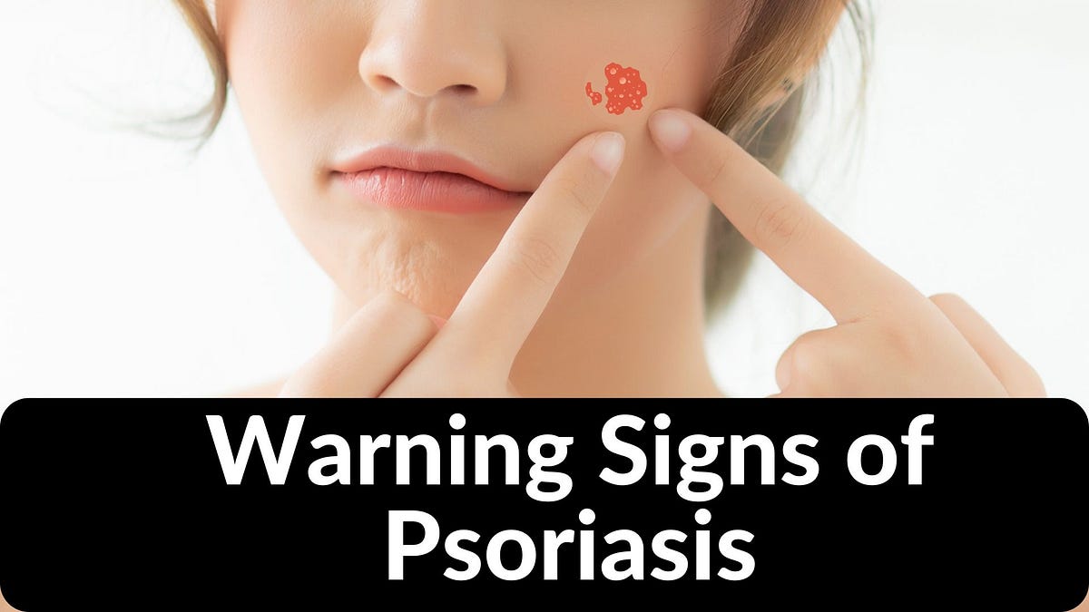 Warning Signs Of Early Stage Psoriasis By Dr Ennajem Medium