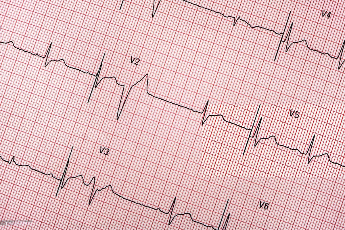 Understanding What Normal ECG and Abnormal ECG Tell Us? | by Sunfox ...