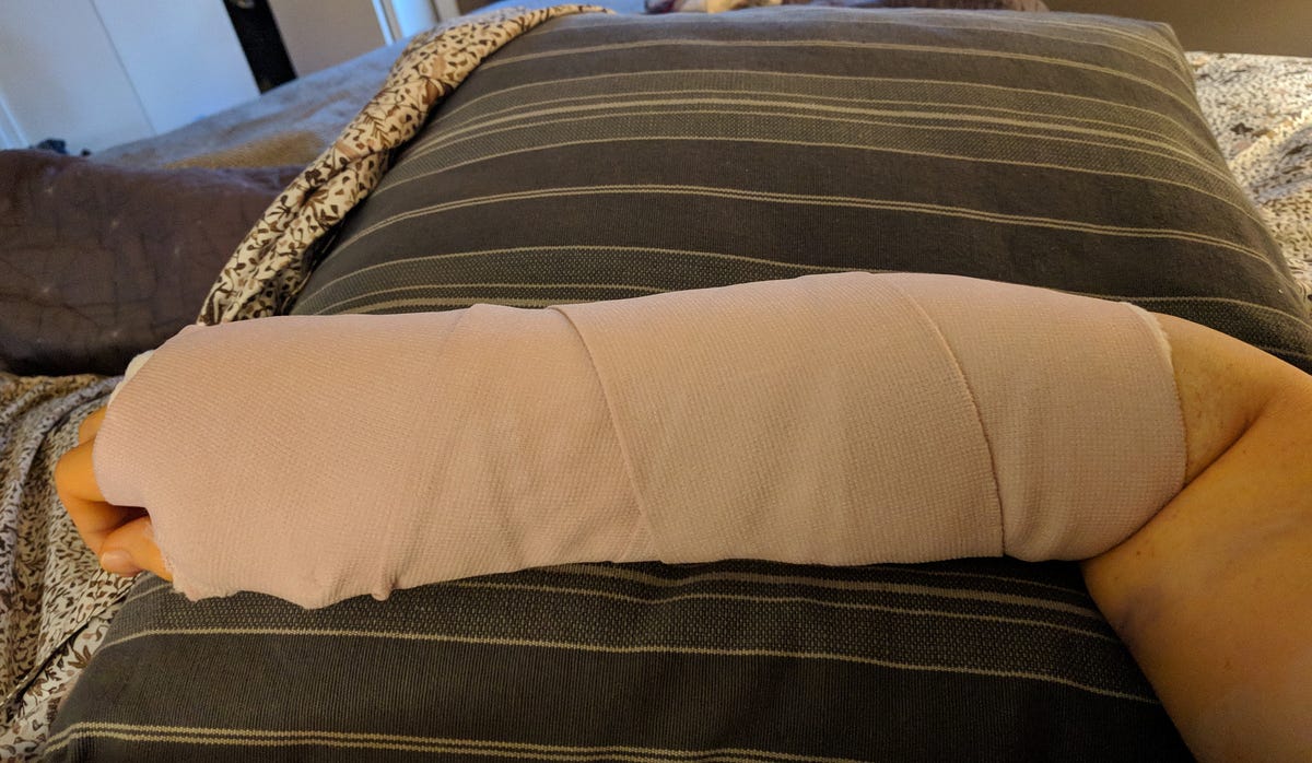 Losing My Arm — And Livelihood — for 1 Month in the Gig Economy | by ...