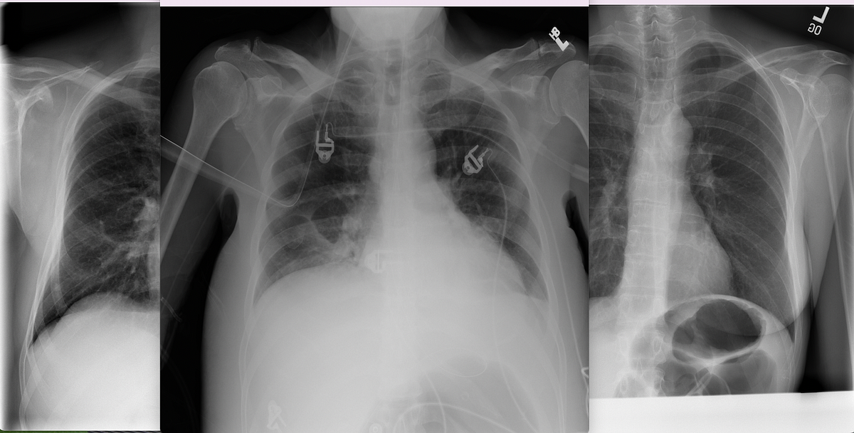 Multi-Categorical Classification of Chest X-Rays | Towards Data Science