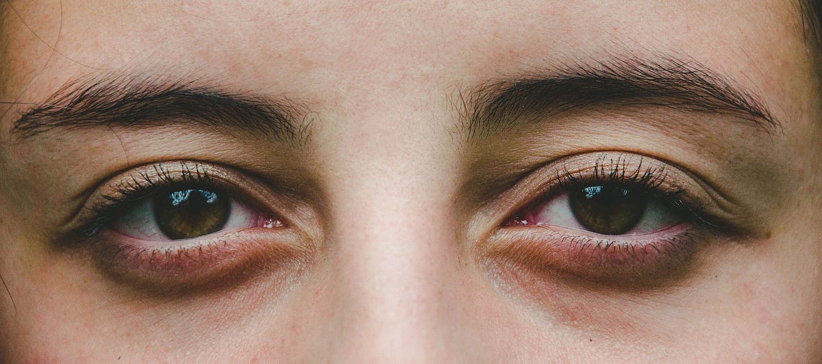 Alison’s Story. In eye care, there are those who are… | by Jenny Cade ...