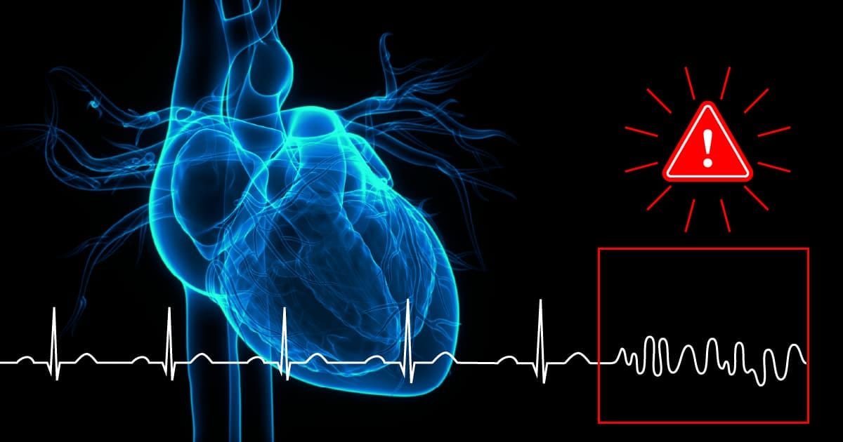 Decoding Arrhythmias Ecg Data Analysis And Dimensionality Reduction By Muhammad Ahmad Medium