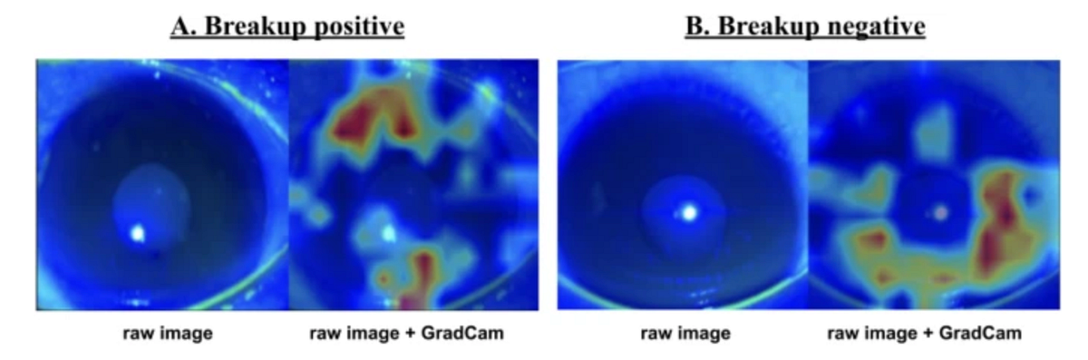 A scientific paper about artificial intelligence-based dry eye disease ...