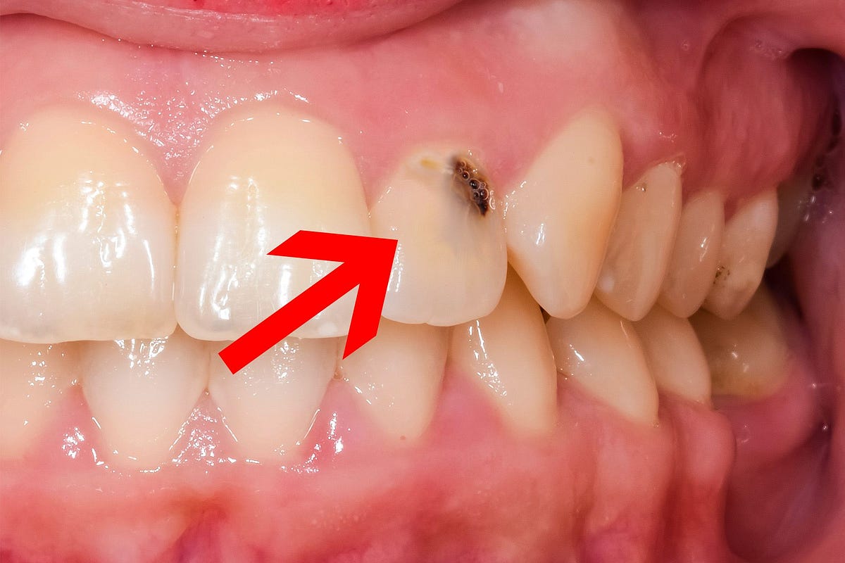 How to Heal Cavities in 2 Days at Home: What You Need to Know | by ...