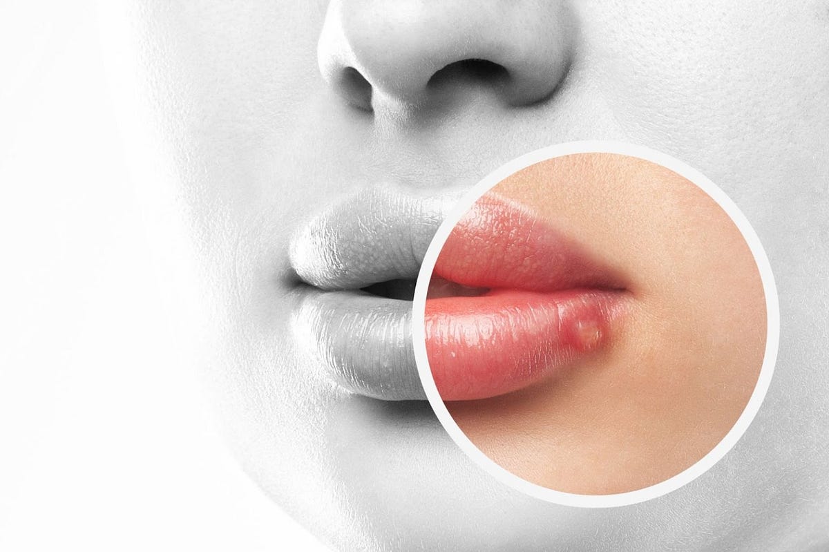 How To Get Rid Of A Pimple On Lip By Amarnathan Aug 2024 Medium