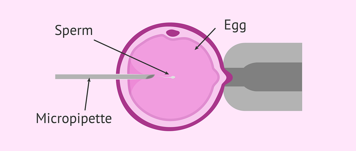 INTRACYTOPLASMIC SPERM INJECTION. Introduction | by Muhammad Umair | Medium