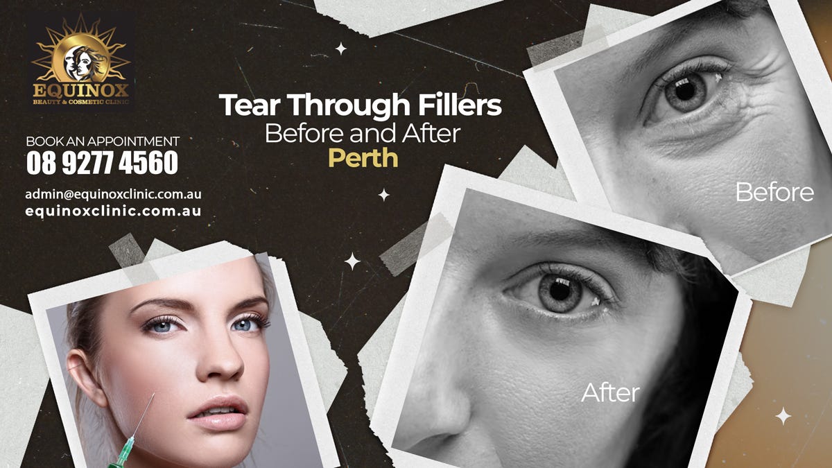 Top 3 Benefits Of Tear Trough Fillers — Reduce Dark Circles Today By