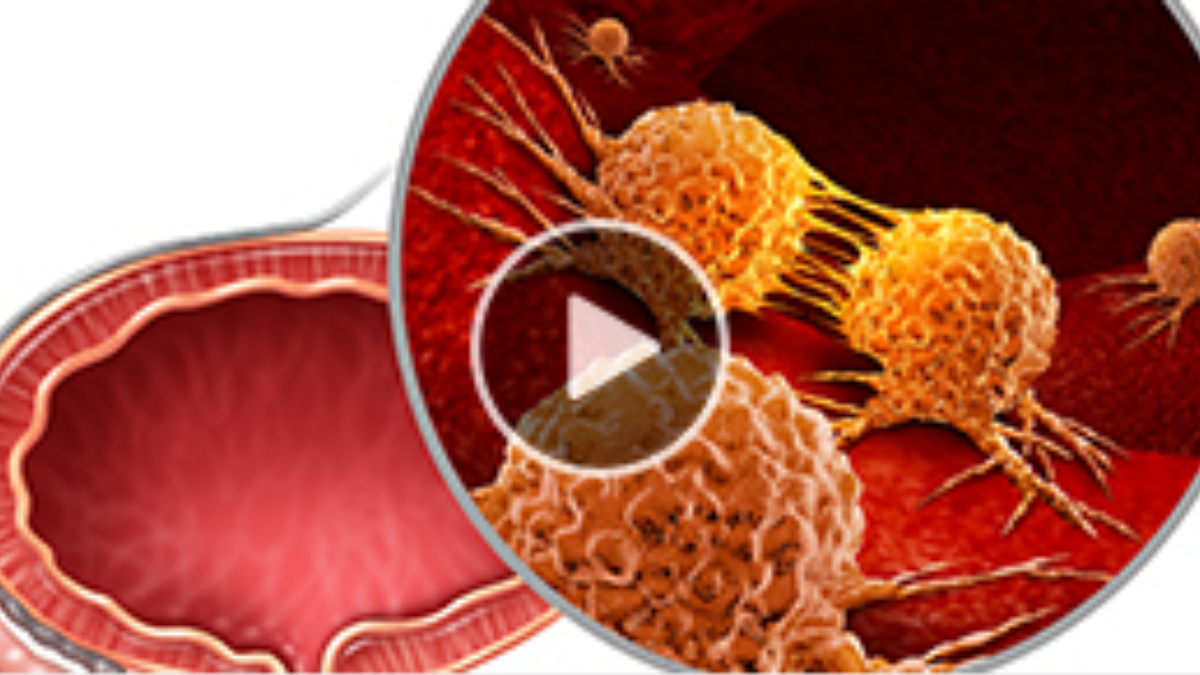 Nurturing Prostate Health: Effective Strategies for a Happy Prostate ...