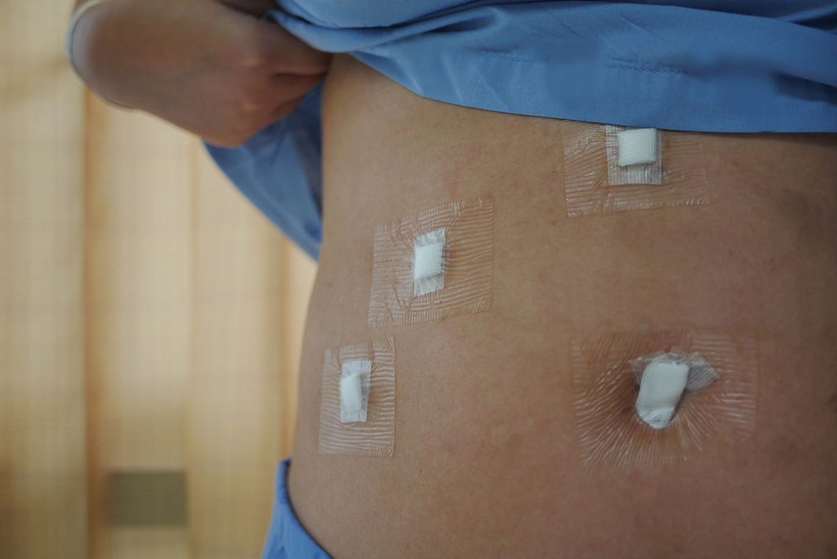 How Soon Can I Take A Bath After Laparoscopic Surgery At Jennette Ince Blog
