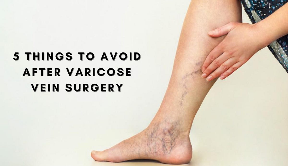 5 things to avoid after varicose vein surgery | by Endovascular Experts ...