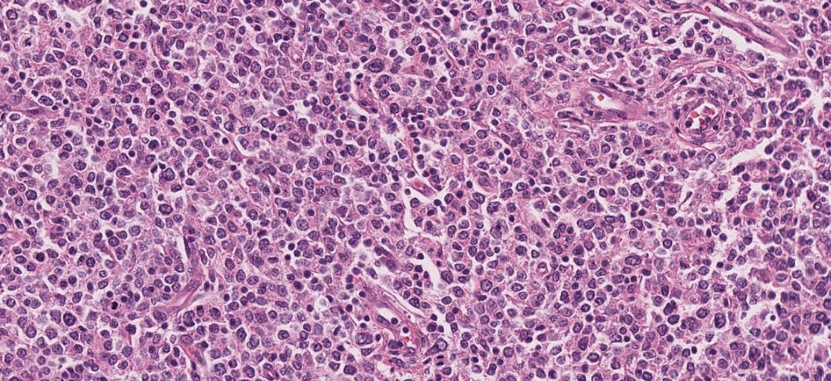 Diffuse Follicular Lymphoma Variant: An Unusual Case with Predominantly ...