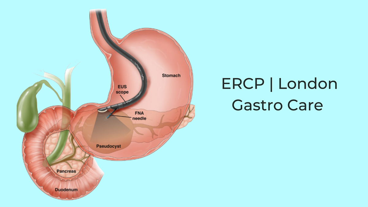 ERCP | London Gastro Care. ERCP is a procedure that uses an… | by ...