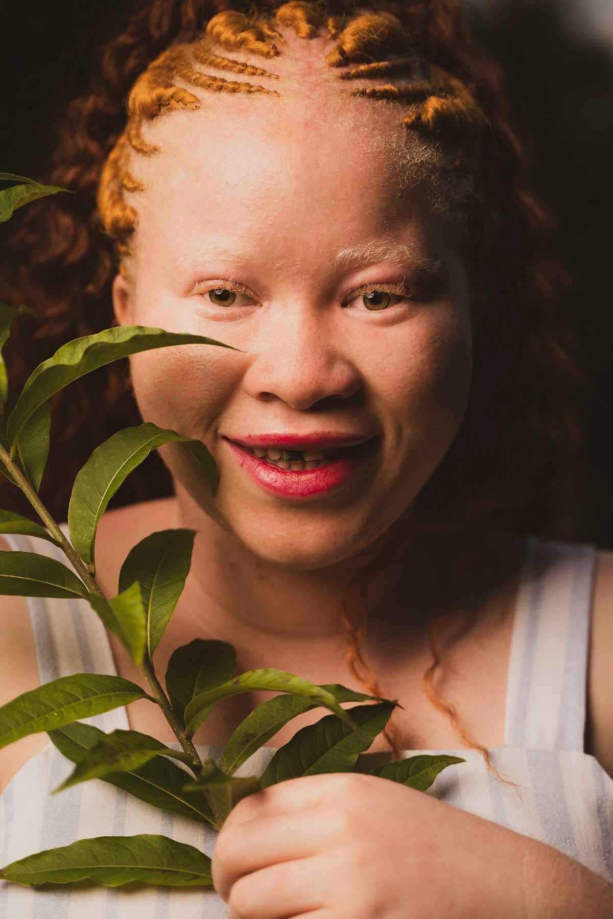 Facts about Albinism You Should Know | by Anthony R. | The Honest ...
