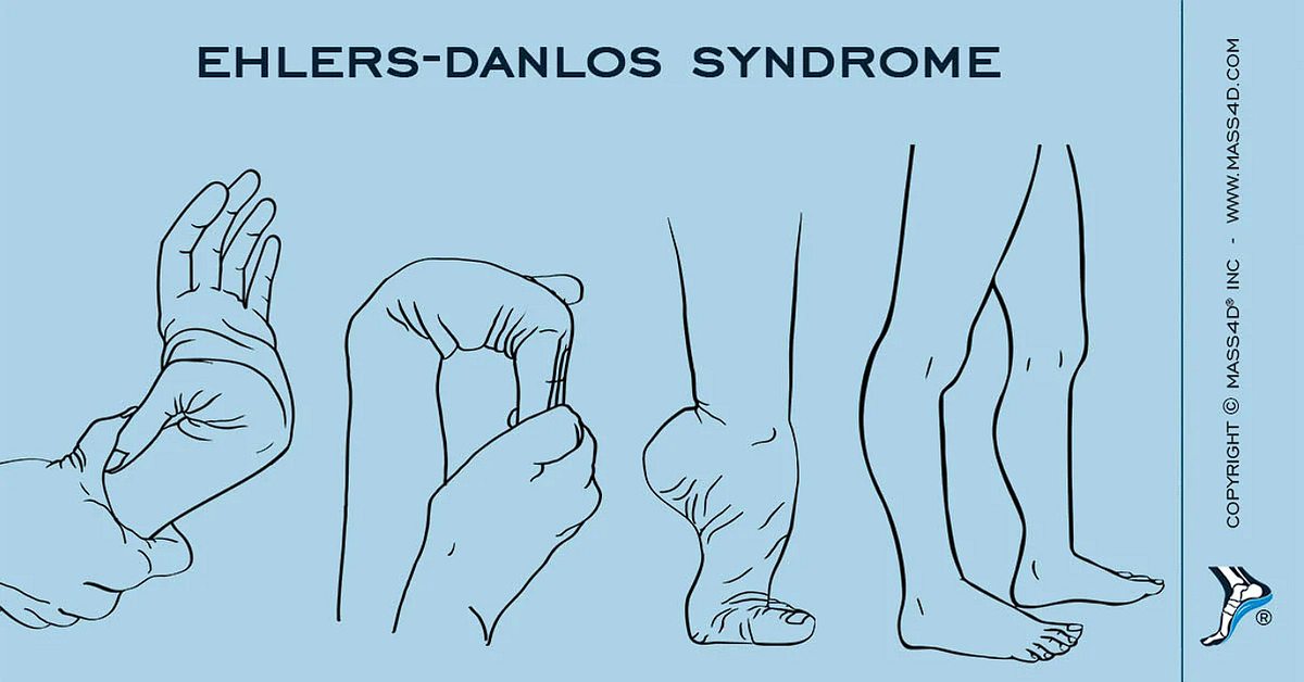 How To Live With Ehlers Danlos Syndrome at Douglas Wilder blog