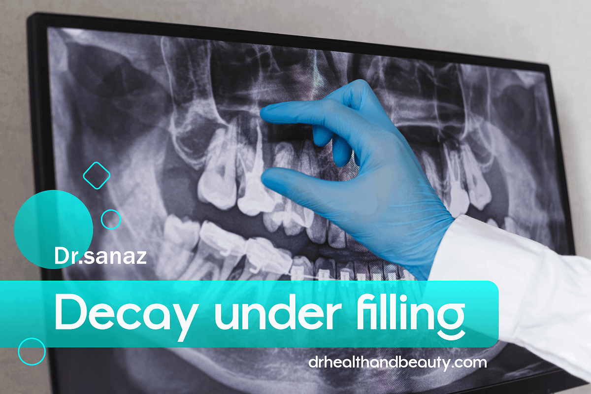 Decay under filling. Lack of proper oral hygiene | by Dr.sanaz bellucci ...