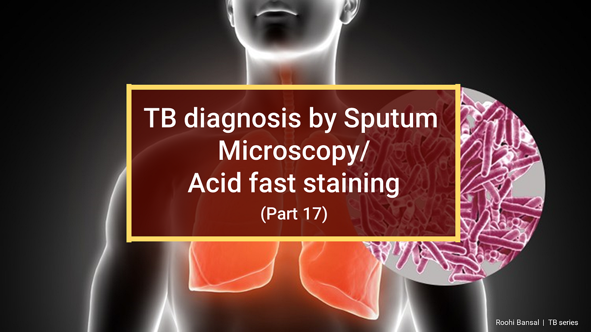 Diagnosis of TB by Sputum Microscopy/Acid fast staining (Part 17) | by Roohi Bansal ...
