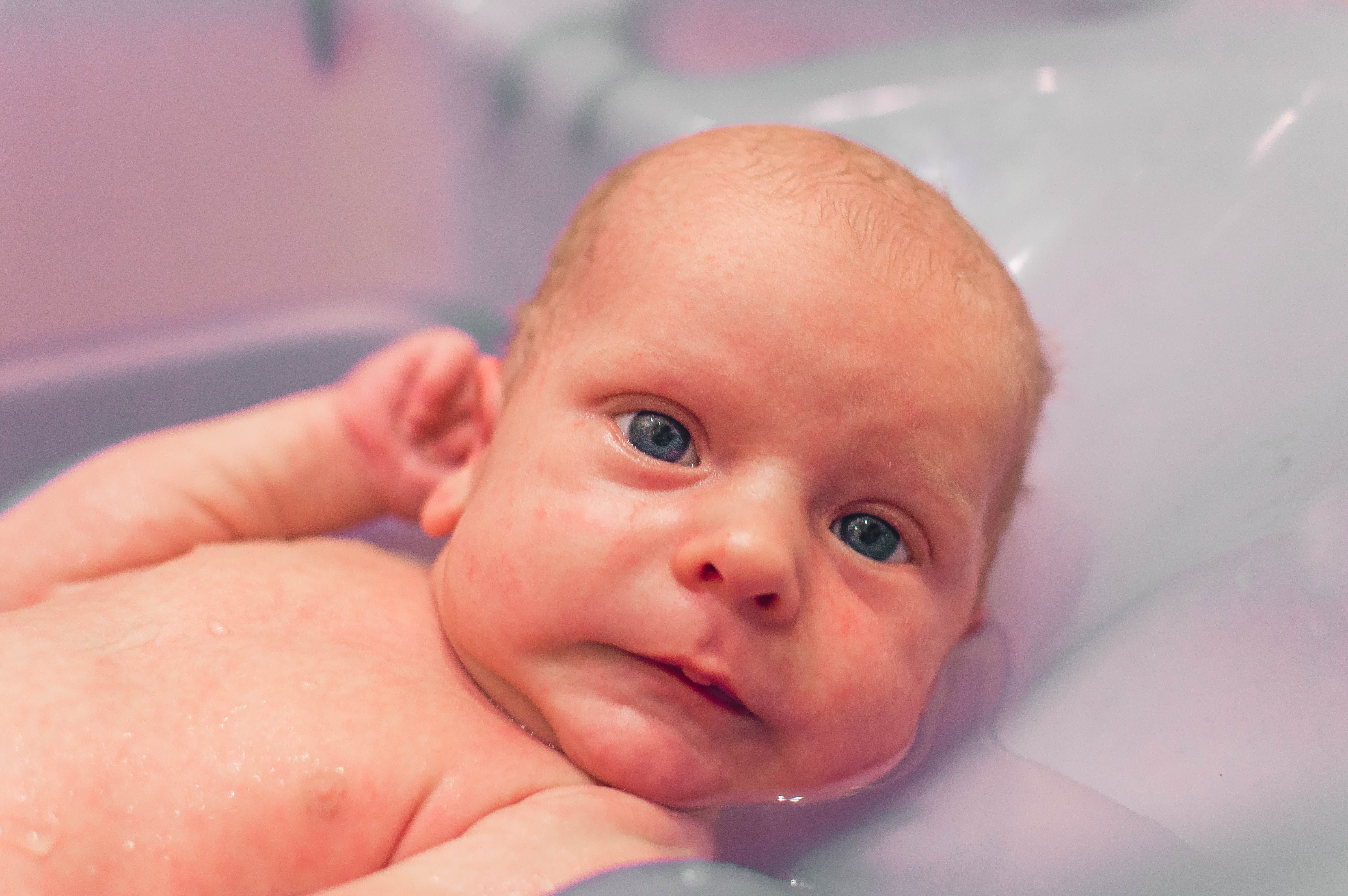 Seborrhoeic Dermatitis Baby