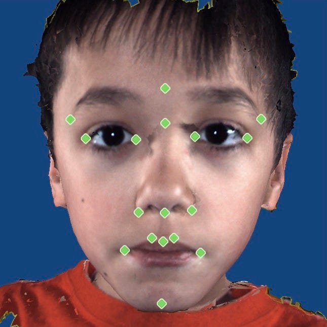 Aspergers Facial Features Autism Spectrum Disorder (ASD) | Peace Of