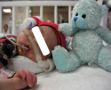 Applying Nasal Interface for Bubble CPAP | by Bcpap Institute | Medium