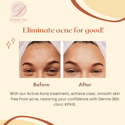 Discover the Best Skin Treatments at Derma 360 in Kukatpally | by ...